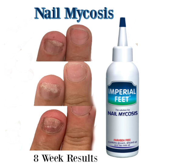Nail Mycosis - Imperial Feet USA